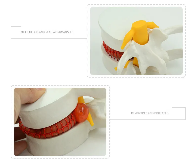 Lumbar Intervertebral Disc Spine Model Extrusion Simulation Spine Model ...