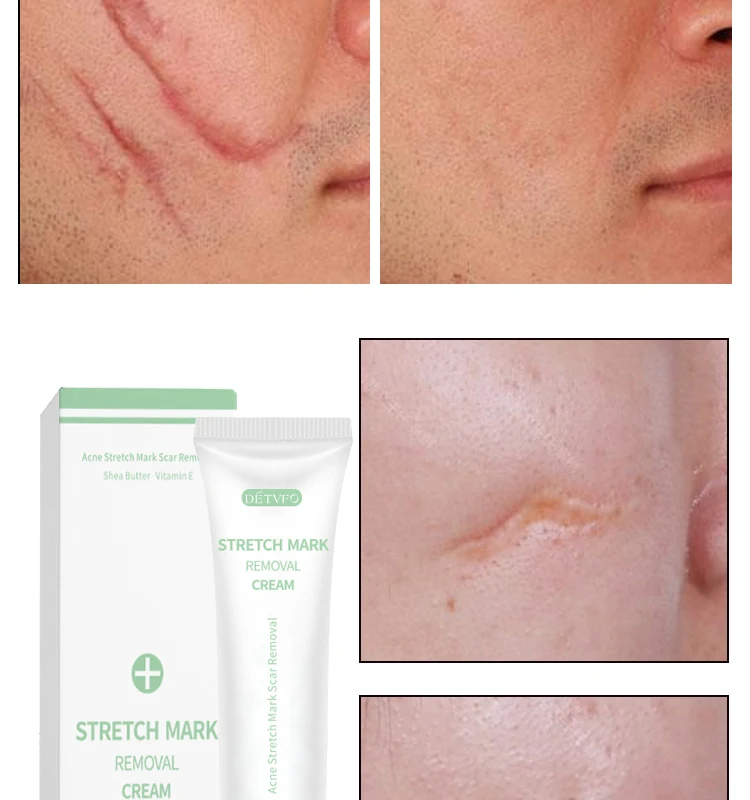 Strong Effective Acne Scar Removal Cream Pimples Stretch Mark Remove ...