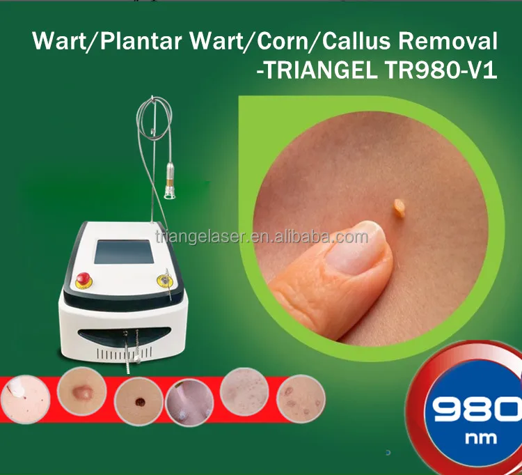 Triangel 30W Laser Wart Removal Machine - Portable & Efficient