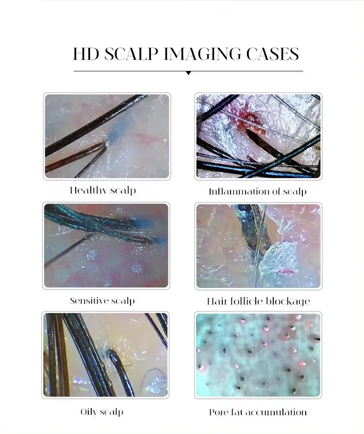 Hd Hair Follicles & Scalp Analyzer - Portable Skin & Hair Analyzer ...