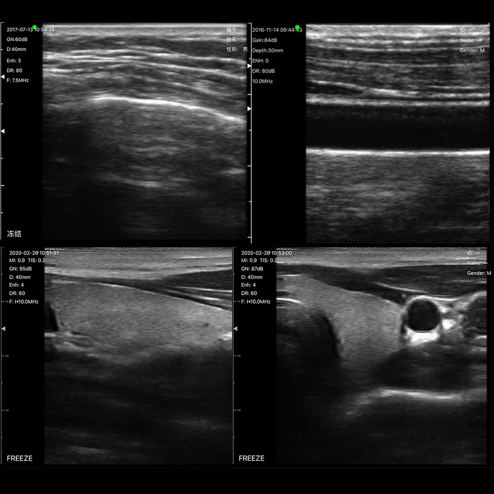 Suresult Portable Ultrasound Machine For Abdomen Convex Scanning And ...