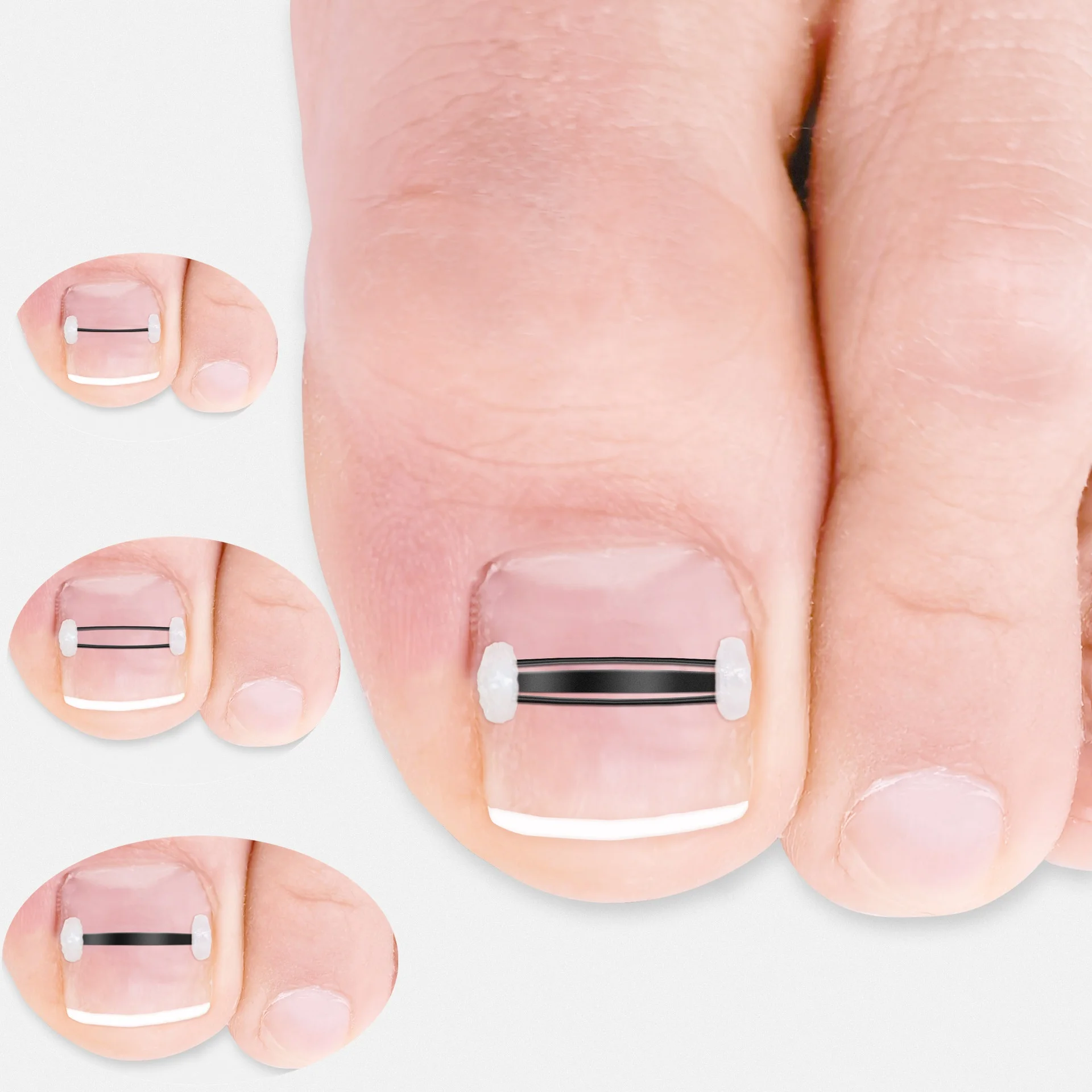 Alibaba.com: Nickel Titanium Alloy Steel Wire, Plastic Nail Patch, CE ...