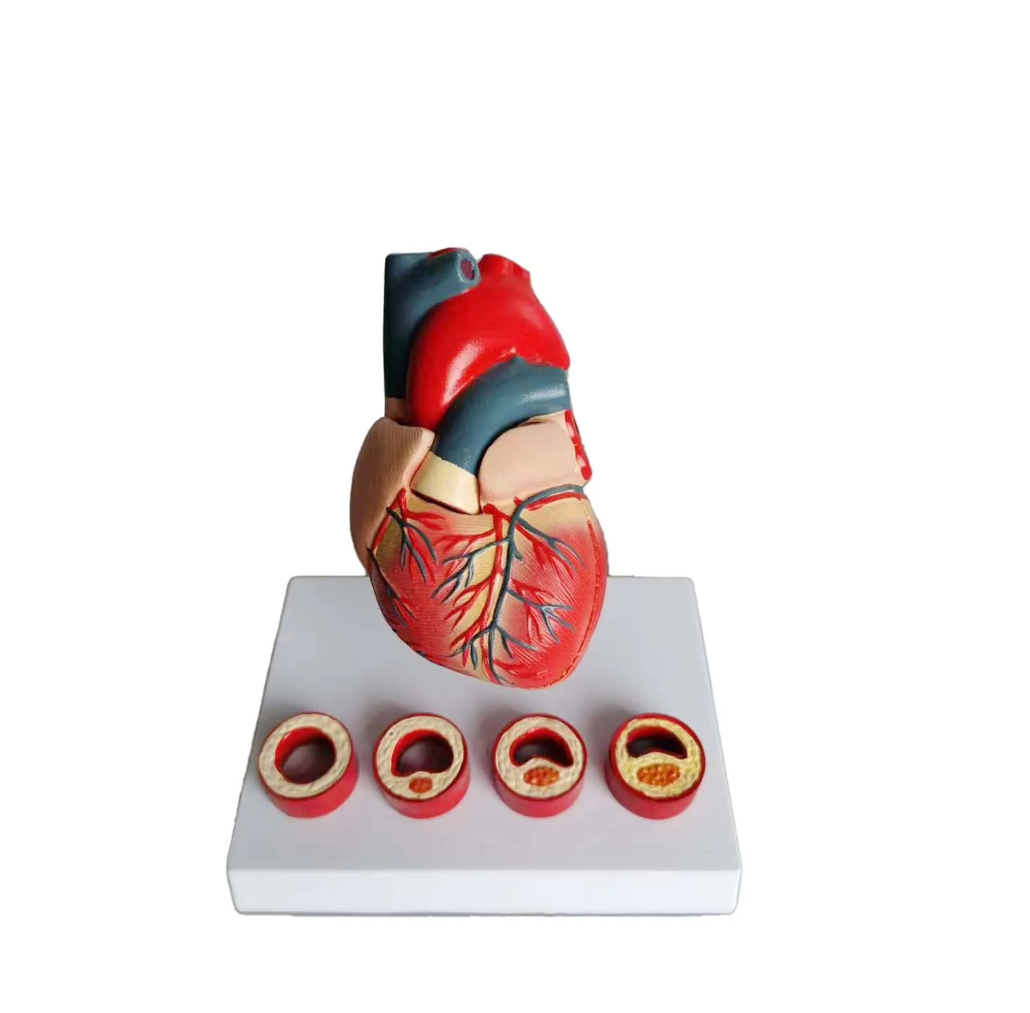 Medical Teaching Cardiac Pathology Model,Coronary Atherosclerotic Heart ...