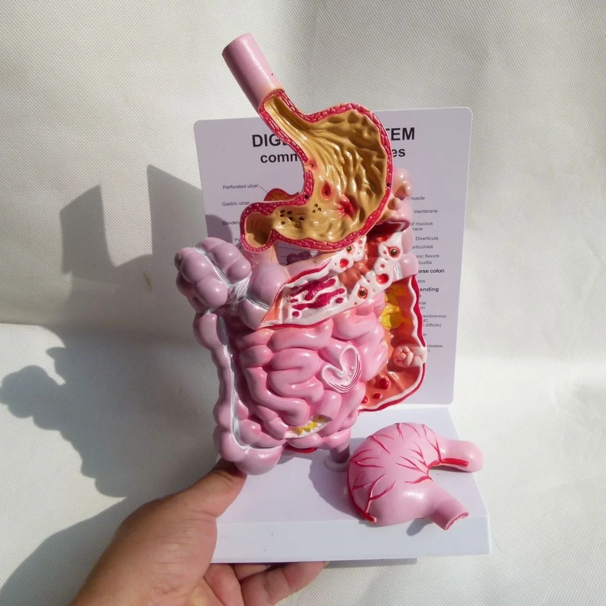 KyrenMed Pathological Human Digestive System Anatomical Model Colon ...