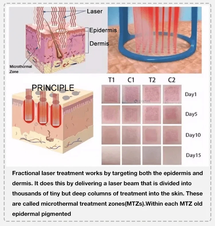 Svatar Cutting Warts Mole Nevus Vaginal Fractional Carbon Facial ...