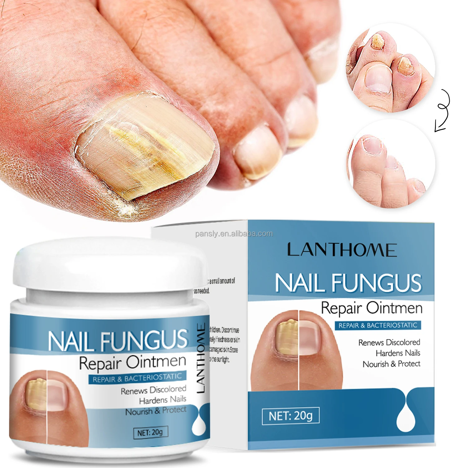 Herbal Nail Fungus Foot Cream Anti-Infection Onychomycosis Paronychia ...