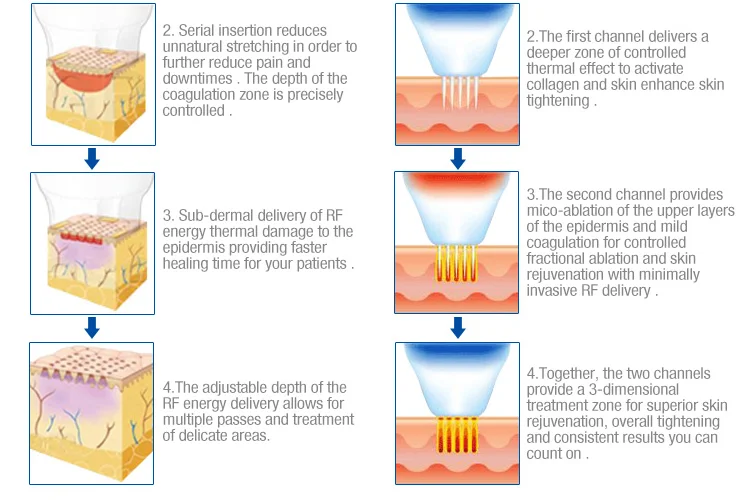 Rf Microneedling Machine Microneedle Radiofrequency Scarlet Rf Skin ...