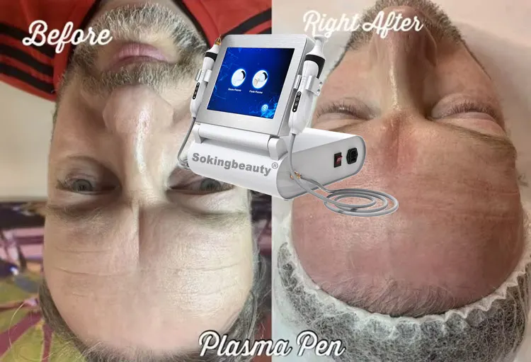 Professional Manufacturer Beauty Machines Fibroblast Plasma Pen Cold ...