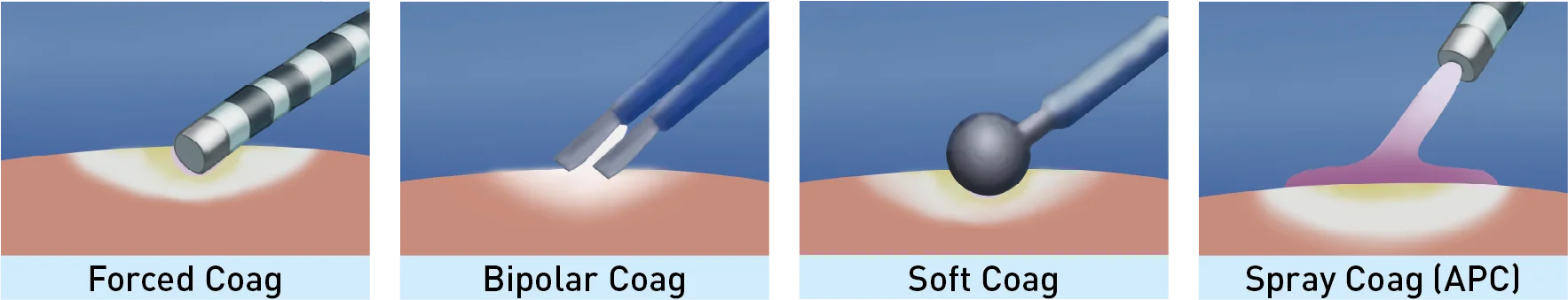 APC Argon Plasma Coagulation Unit - Reliable Surgery Device with ...
