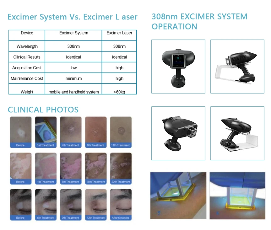 Handheld Designed Excimer System Mobile for Psoriasis Eczema 308nm ...