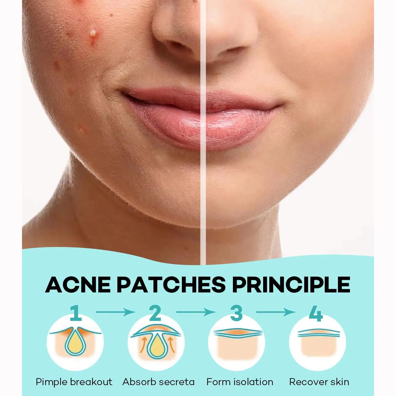 Cute Cartoon Blemish Spot Hydrocolloid Pimple Patch Skin Treatment for ...
