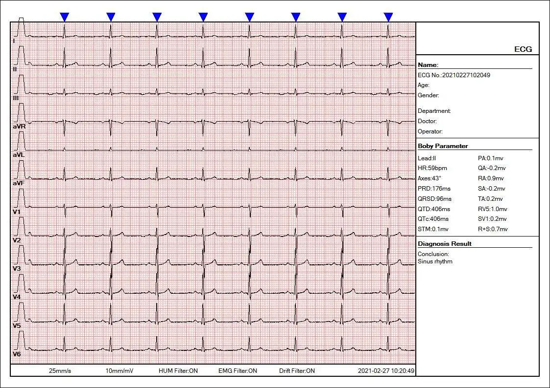 De06-vet Veterinary Electrocardiogram Ecg Interpretation Ventricular ...