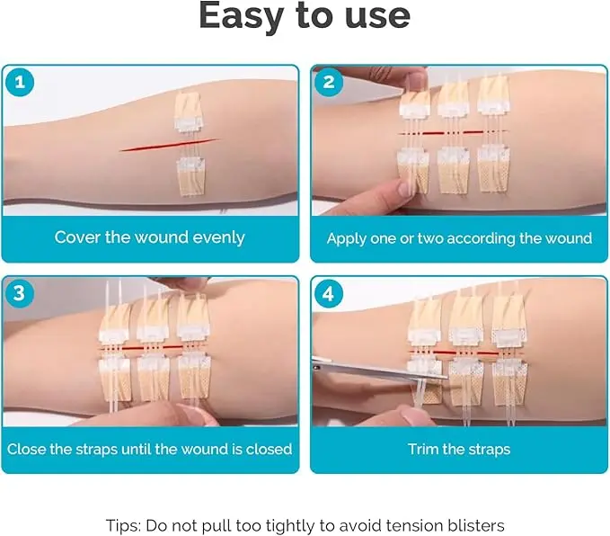 Laceration Wound Closure Device, Emergency Laceration Closure Strips to ...