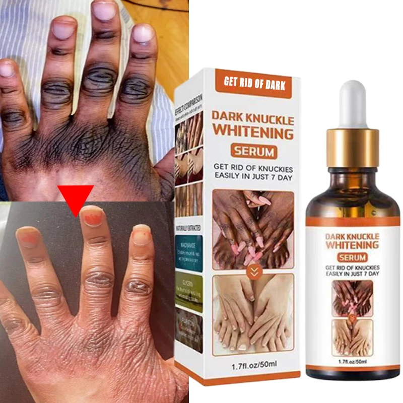 7 Days Nicotinamide Black Fingers Remover,Oem Nicotinamide Get Rid Of ...