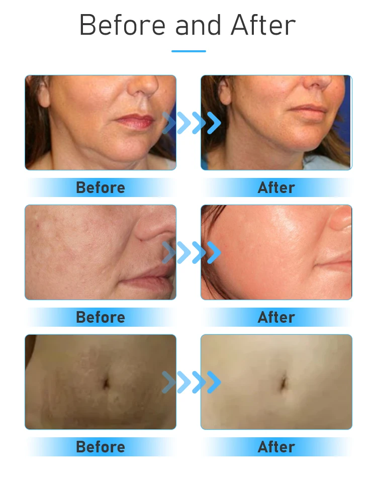 Portable 2in1 Radio Frequency Fractional Rf Microneedling Skin ...