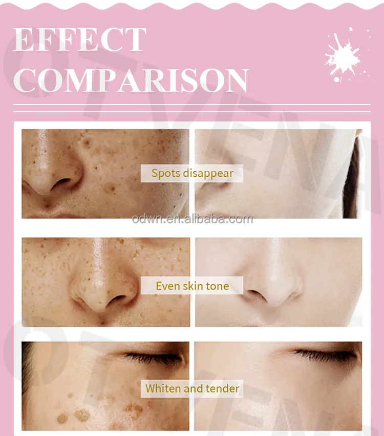 Facial Lightening Freckle Blemish Melasma Dark Spot Corrector Remover Whitening Cream| Alibaba.com