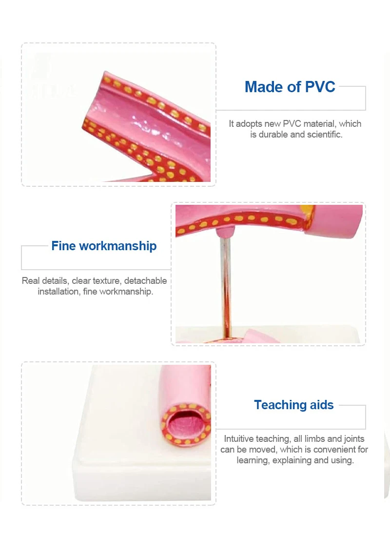 Anatomical Human Blood Vessel Model Arteriosclerosis Model With ...
