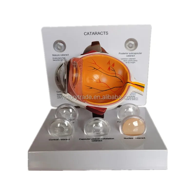 V-am029 Plastic Human 3d Cataracts Anatomical Eye Model With 5 ...