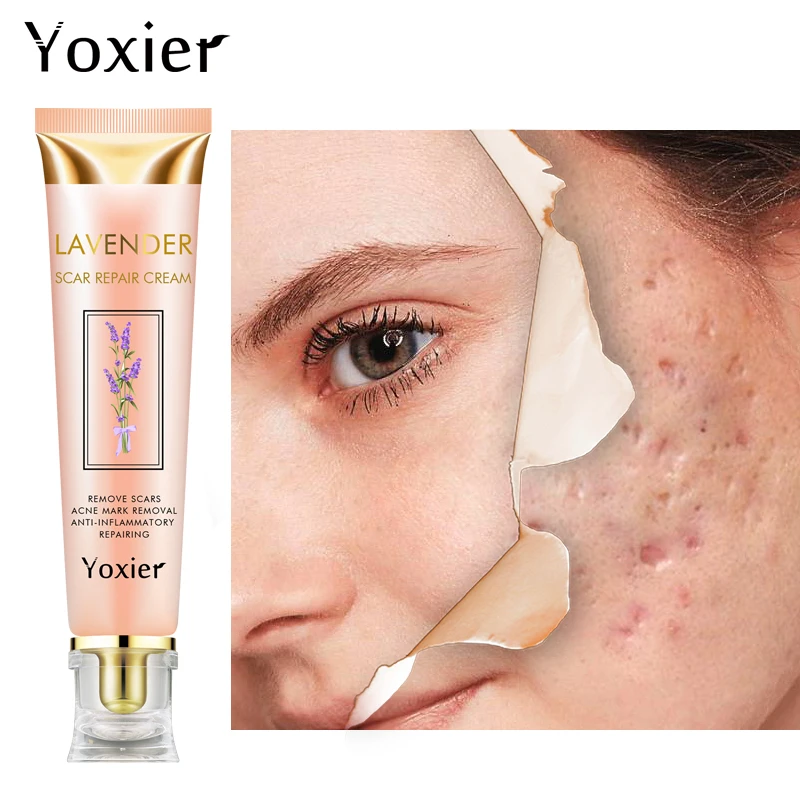 Yoxier Scar Removal Treatment Acne Face And Stretch Mark Removal Cream ...