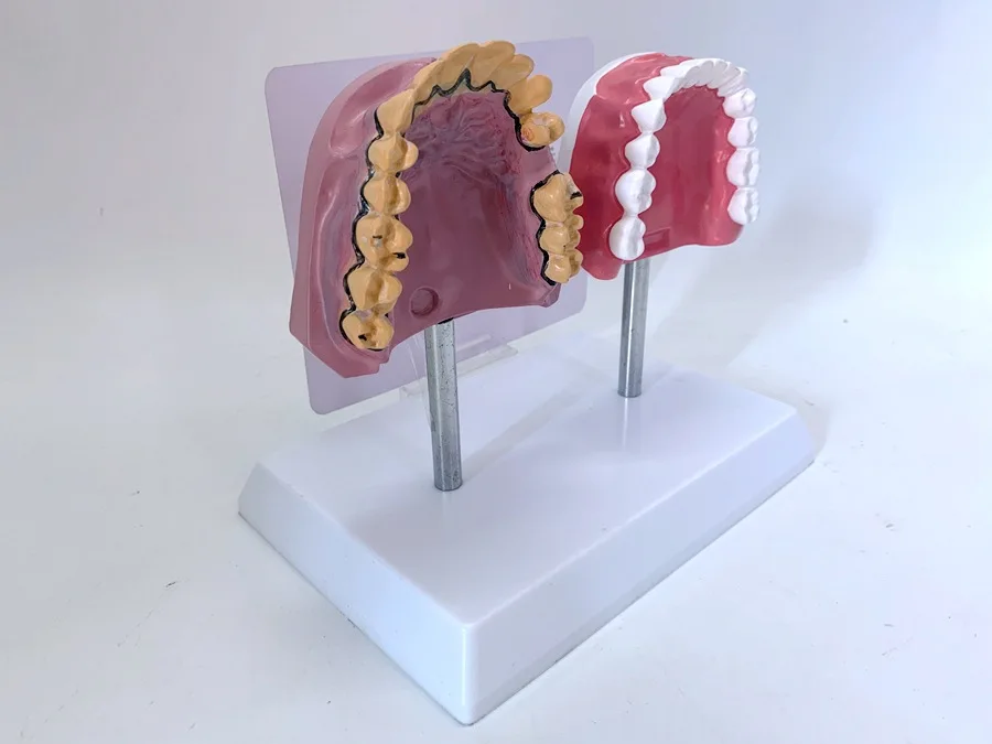 Dental Anatomical Model Pathological Tooth Model Comparison Model Of ...