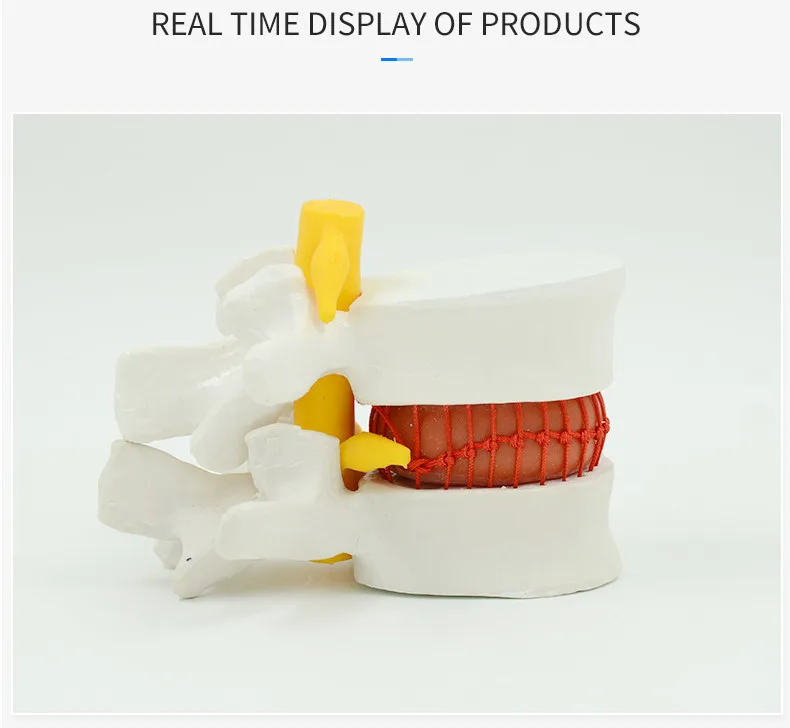 Lumbar Intervertebral Disc Spine Model Extrusion Simulation Spine Model ...