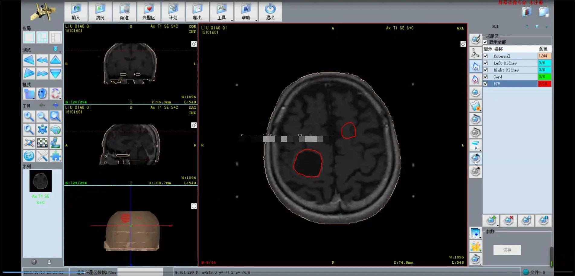 Gama Knife Minimally Invasive Neurosurgery Brain System