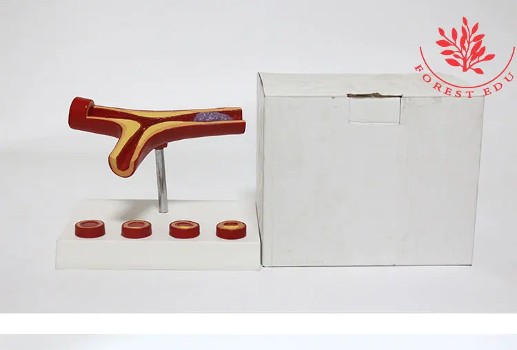 Artery and Blood Vessel Model - Understanding Atherosclerosis