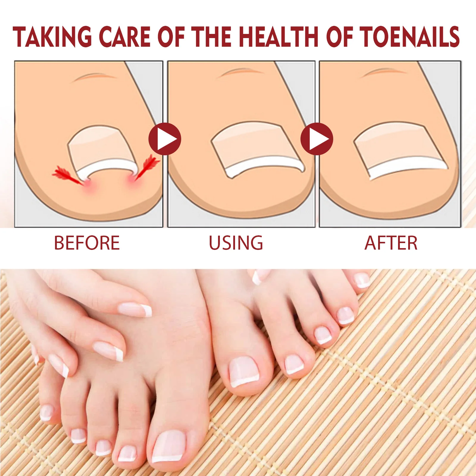Jaysuing Anti Paronychia Relief Oil Toe And Fingernail Repair For ...