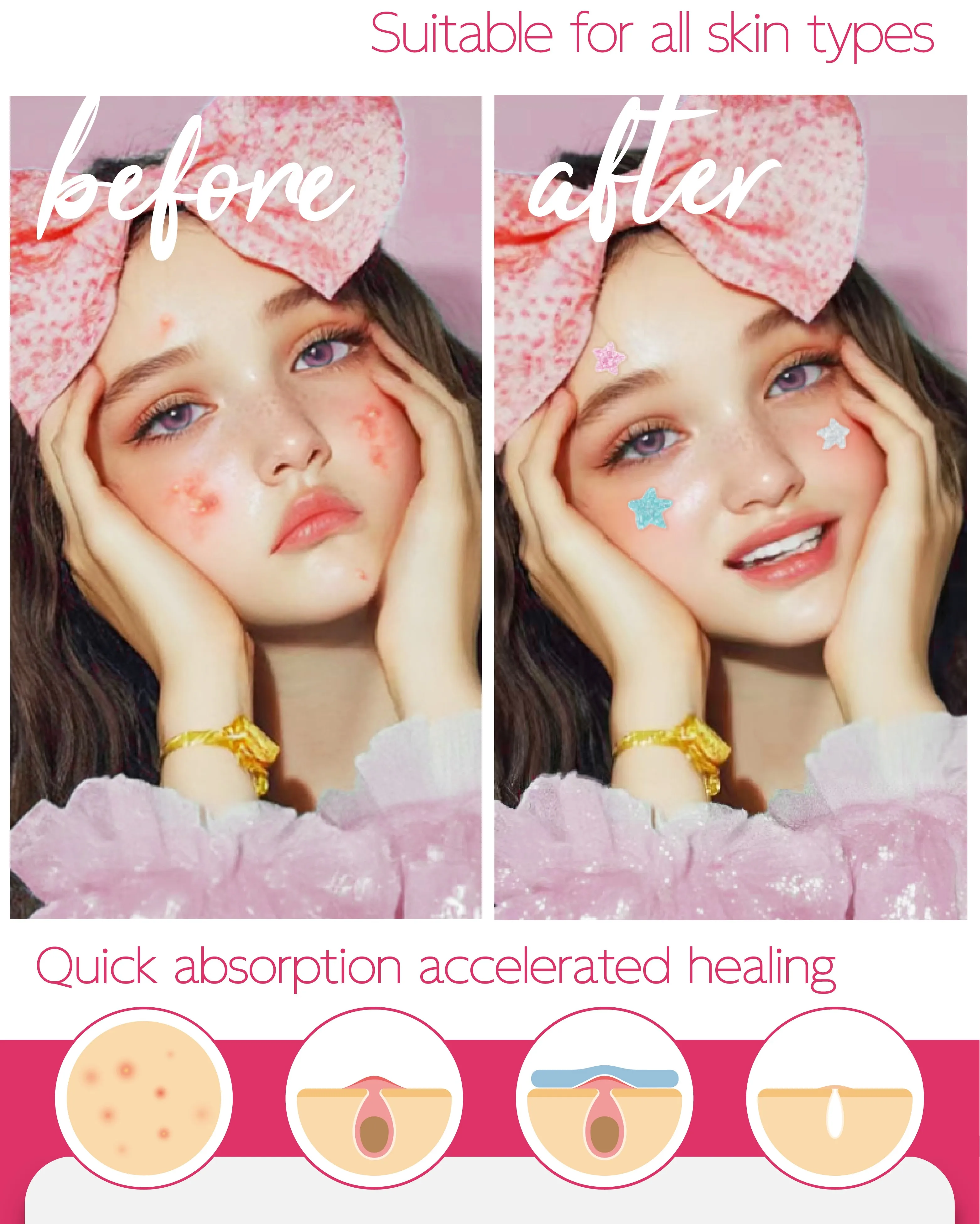 Flower Glitter Blemish Spot Patch Hydrocolloid Skin Treatment Pimple ...