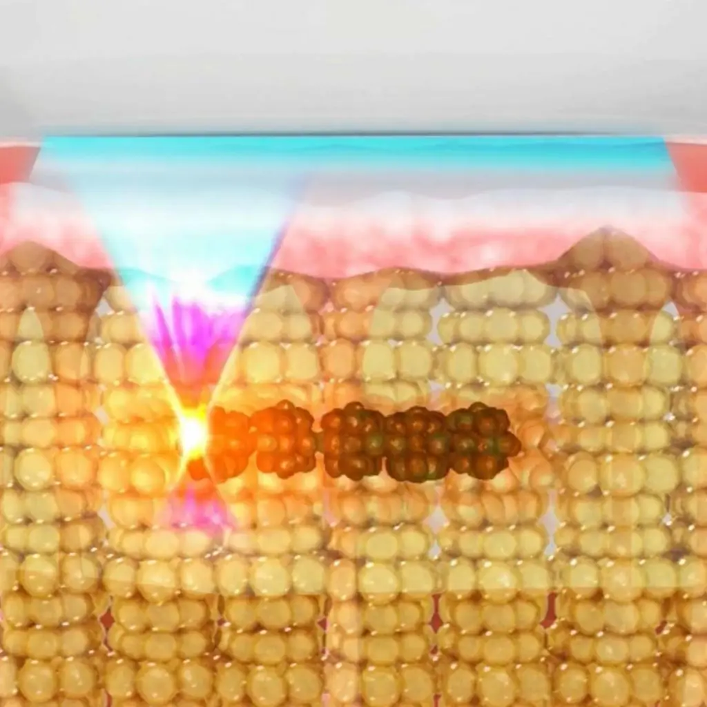 2026 Newest MFSU Macro Focused Scanning ultra Slimming Machine for Skin ...