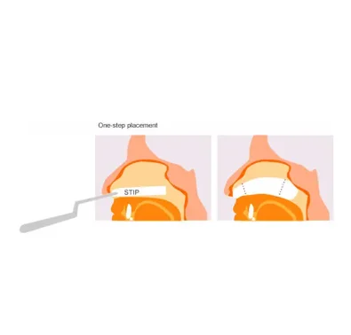 Hospital Safe And Soft Instant Nosebleed Hemostasis Pva Nasal Dressing ...