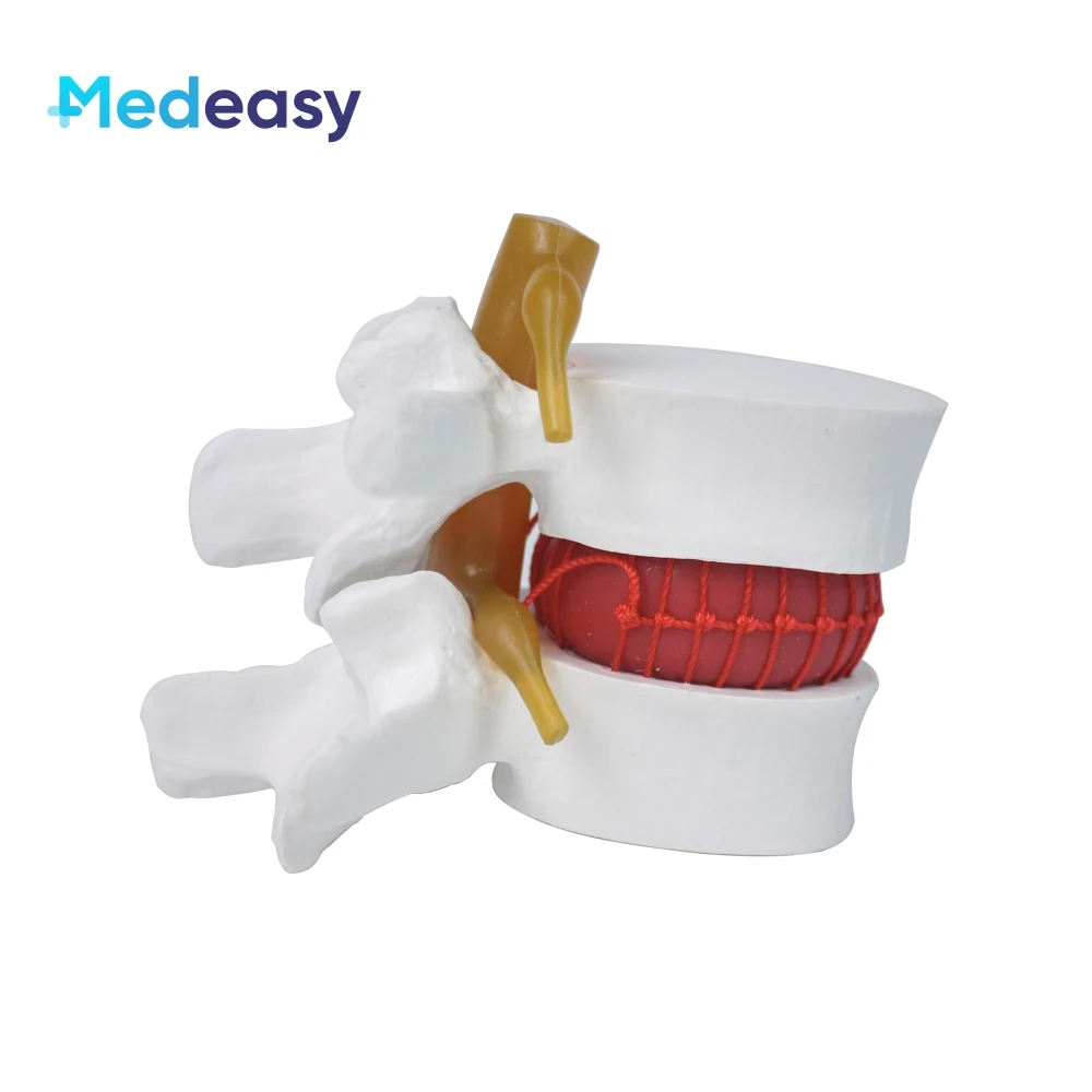 Lumbar Disc Herniation Model - Educational Anatomical Tool