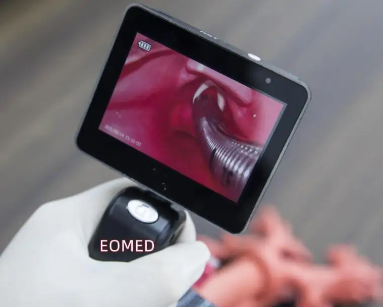 Portable Affordable True View Video Laryngoscopy Easy Intubation ...