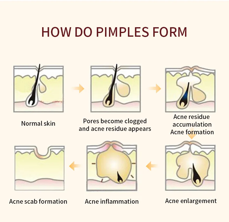 Best Selling Hydrocolloid Acne Patches Salicylic Acid with Tea Tree Oil ...