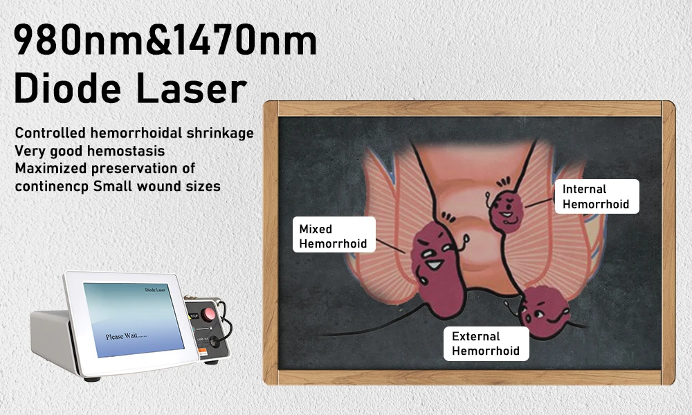 Piles Treatment Hemorrhoids Removal 1470nm Diode Laser Hemorroides ...