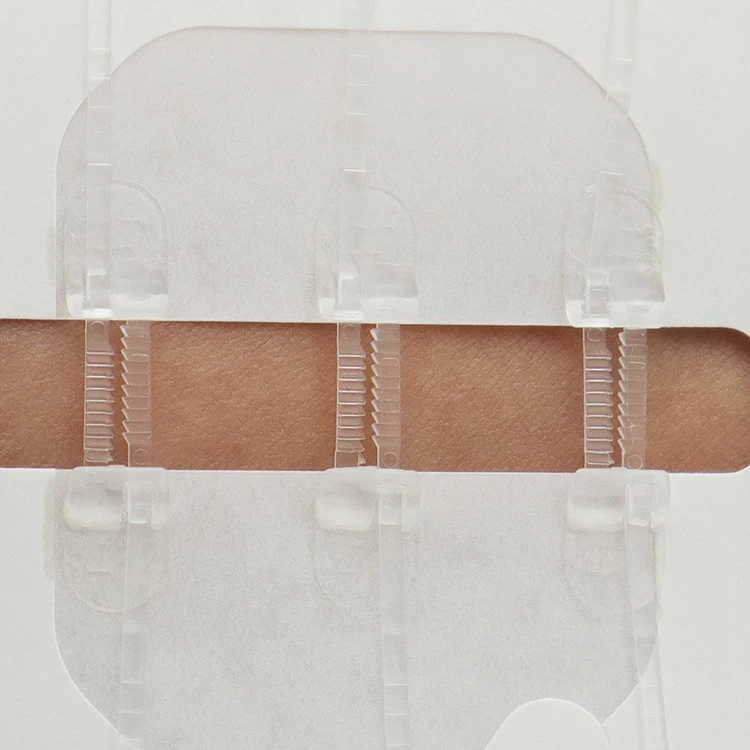 Trummed Medical Zip Stitches - Non-Invasive Wound Closure