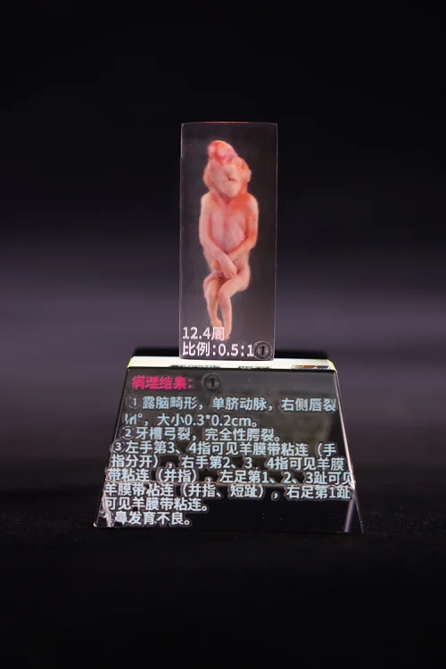 3d Printed Embryo Model Of Malformed Embryos Embryology Learning For ...