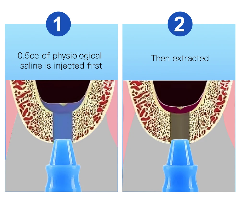 Hydraulic Maxillary Sinus Lifting Tool - High Quality Implant