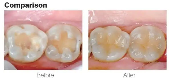 DX. Posterior Light Cure Composite Resins, Dental Composite, Filling ...