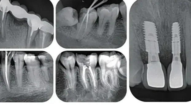 High Definition X-ray Image Scanning Scanner Machine Dental Imaging ...