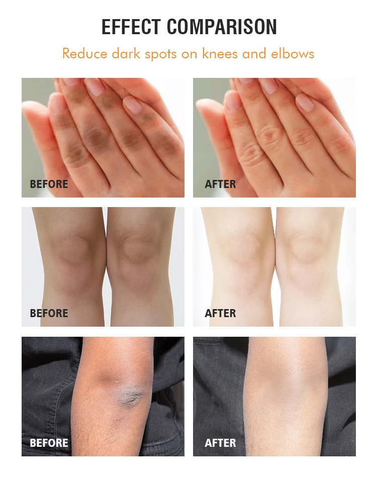 Private Label Dark Knees and Elbows Strong Whitening Cream