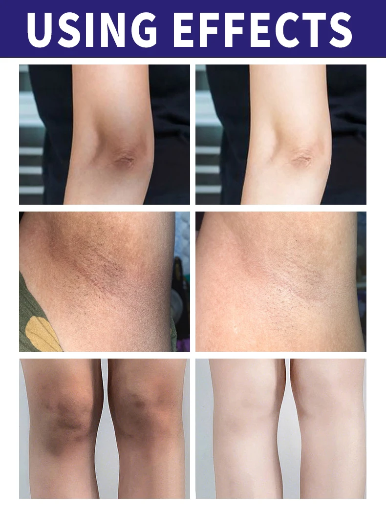 DETVFO Dark Knees Elbows Whitening Cream - Fast Action