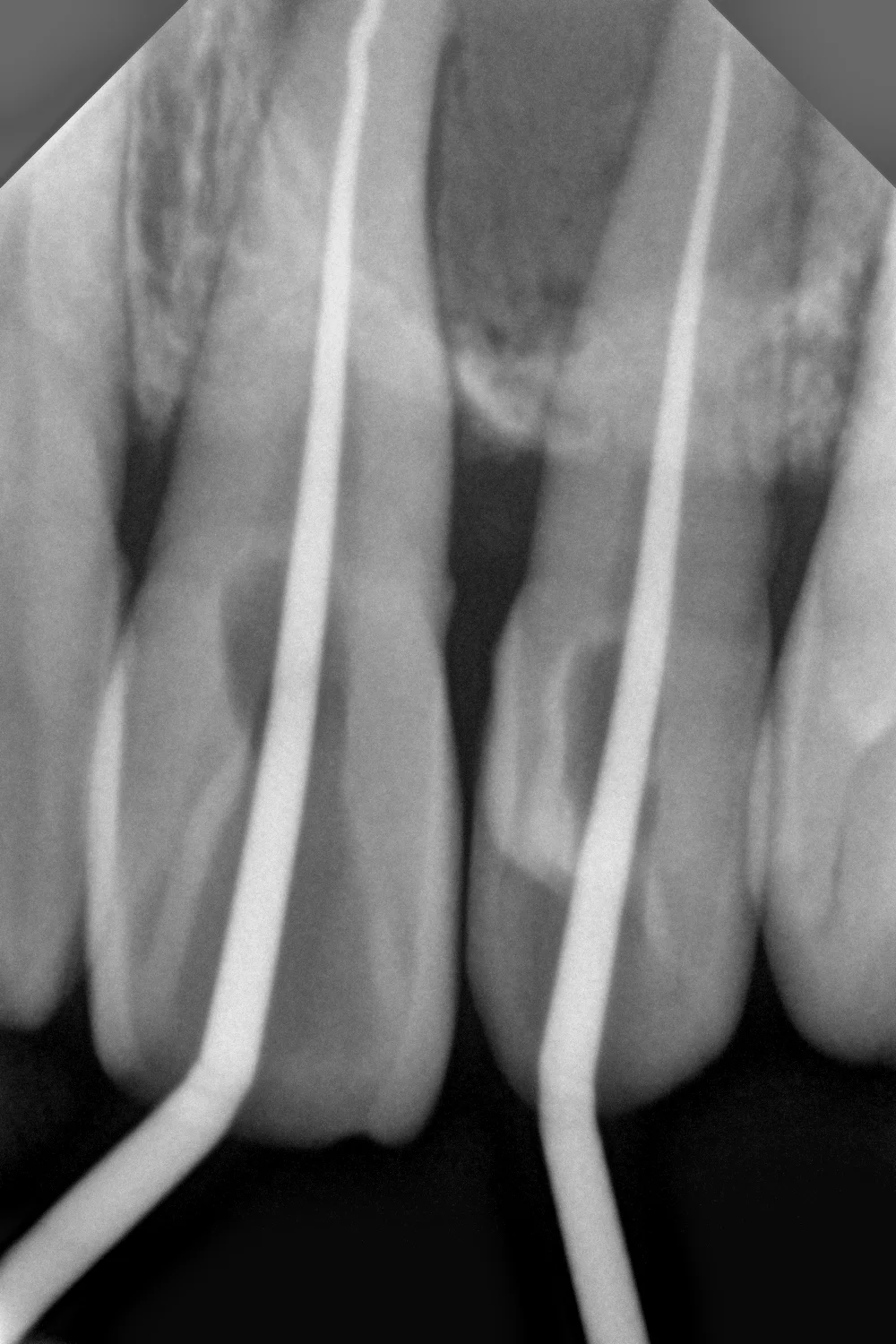 Iray Dental X Ray Intraoral Sensor Hot Sale Digital Intra-oral Sensor ...