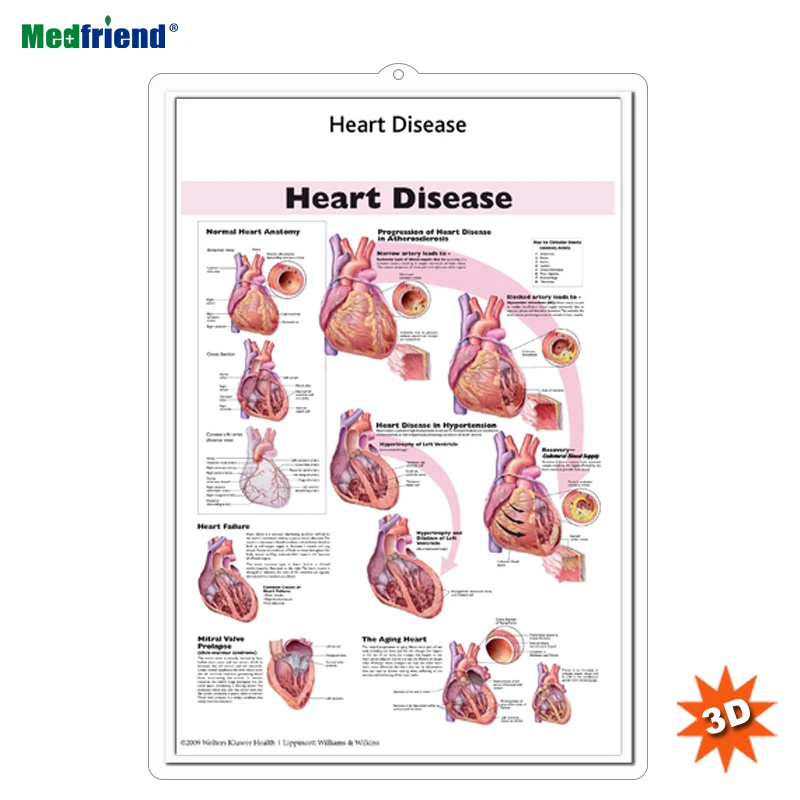 3D Medical Human Anatomical Wall Chart / Poster - Heart Disease ...