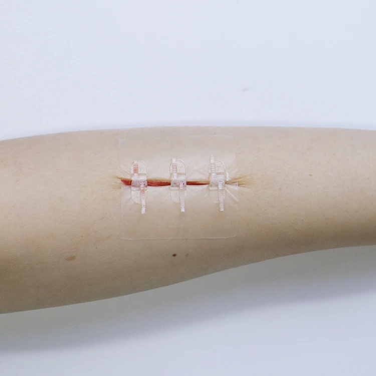 Trummed Medical Zip Stitches - Non-Invasive Wound Closure