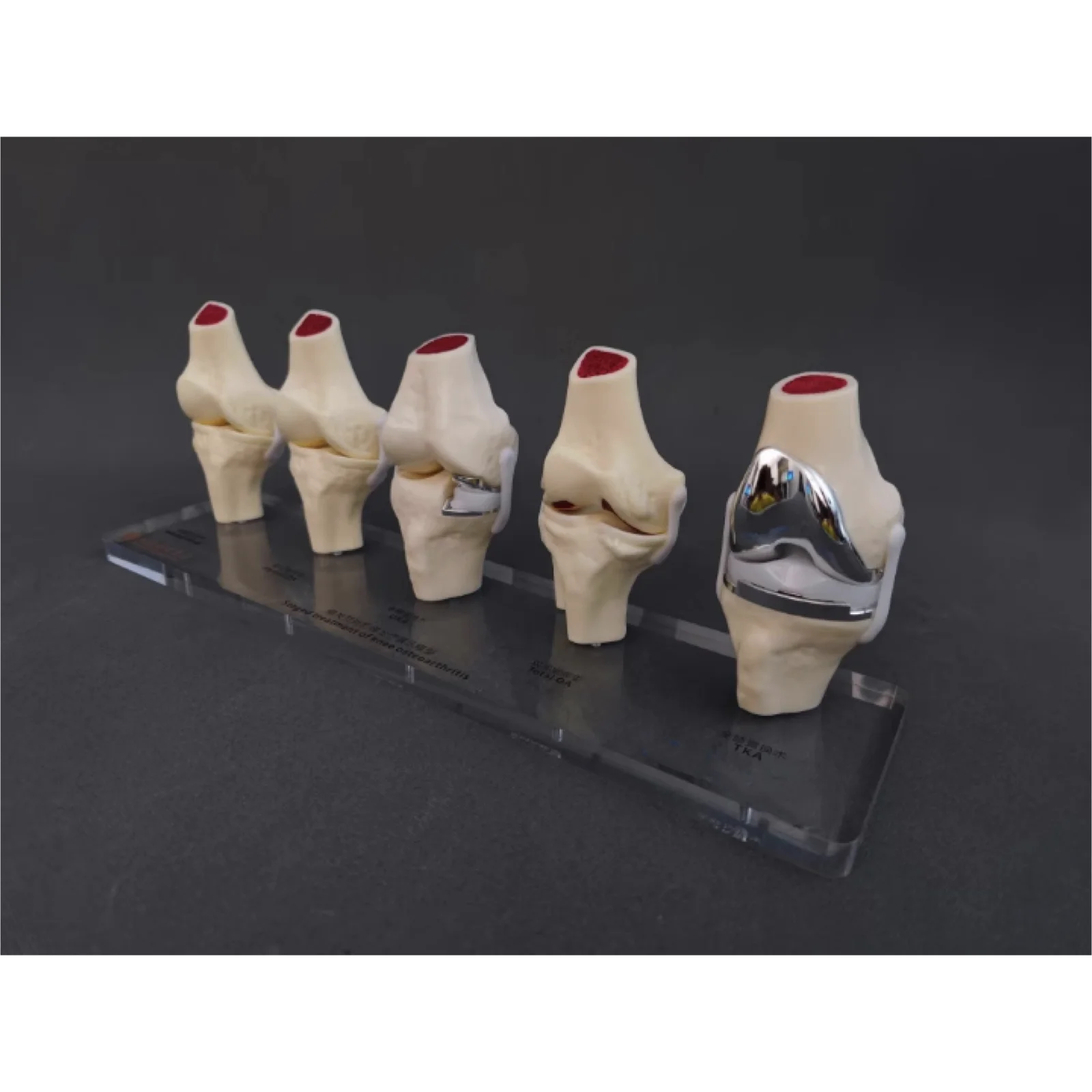 Kyrenmed Knee Osteoarthritis Staircase Treatment Model 5-stage Knee ...