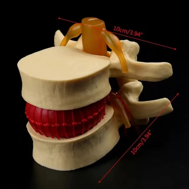 Human Demonstration Intervertebral Disc Herniation Model - Buy Lumbar ...