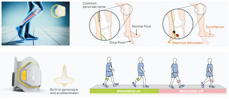 FES Professional Foot Drop System XFT G3 for Drop Foot Treatment