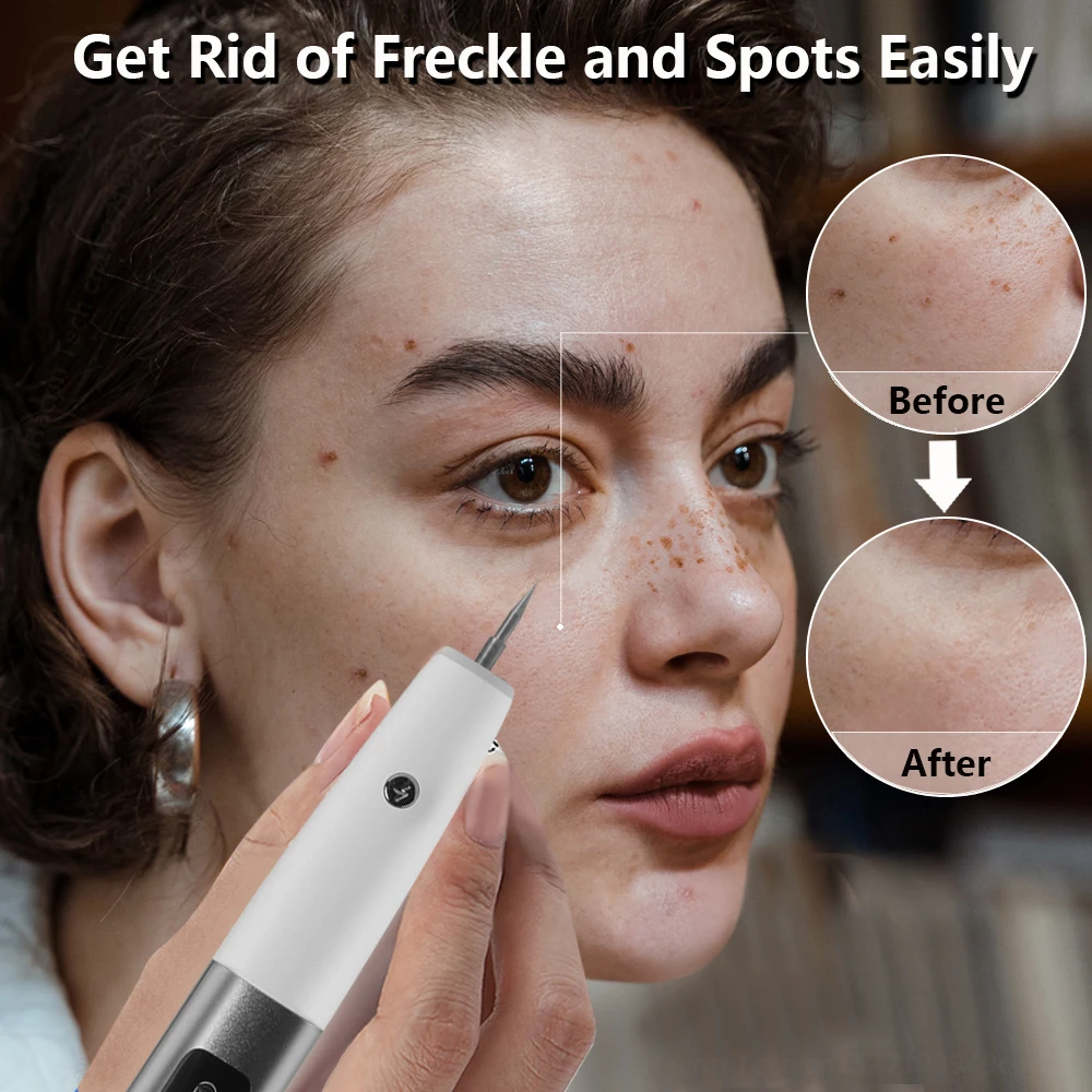 Mole Remover for Dark Spots, Freckles, Warts & Pimples