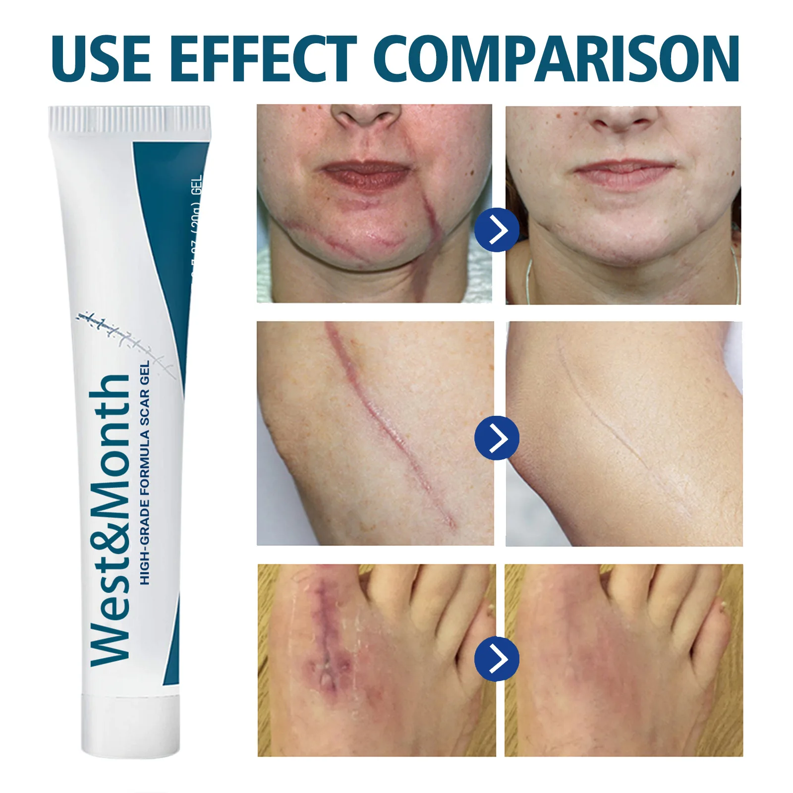 West&Month Fade Body Scar Repair Gel Cream - Nourishing Scar Treatment ...